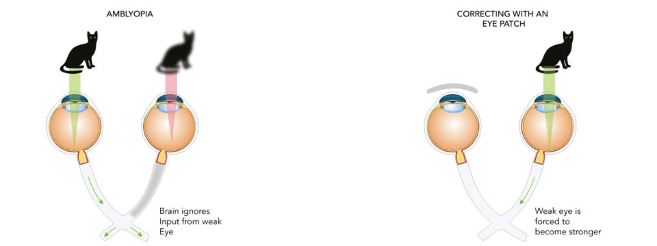 Enhance Vision: Amblyopia Therapy Solutions in Victoria